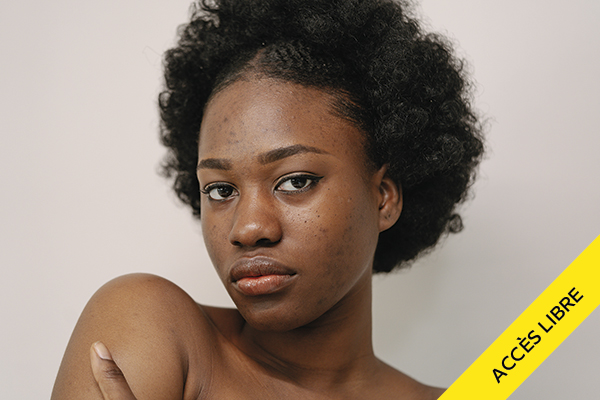 Hyperpigmentation : un mal qui fait tache sur les peaux foncées - Revue ...